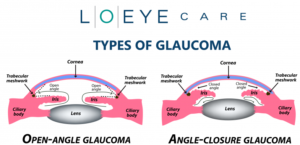 Did you know there are different types of Glaucoma? - LO Eye Care